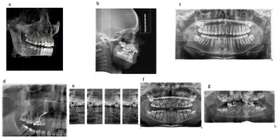 Frequency of Dental X-ray Diagnostics in Children and Adolescents: What ...