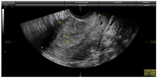 Learning Curve for Ultrasound Assessment of Myometrial Infiltration in ...