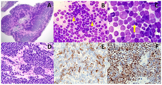 Combined Merkel Cell Carcinoma with Nodal Presentation: Report of a ...