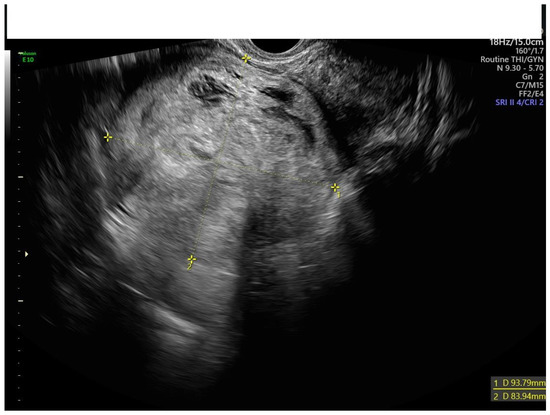 How Frequently Benign Uterine Myomas Appear Suspicious for Sarcoma as ...