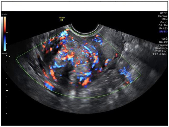 Diagnostics | Special Issue : Advances in Gynecological Ultrasound