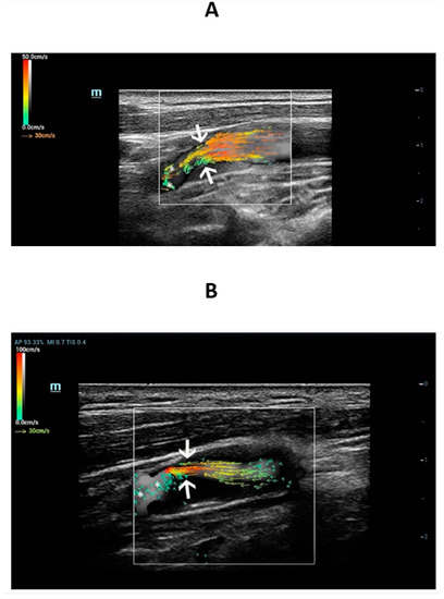 Clinical Application of High-Frame-Rate Vector Flow Imaging in ...
