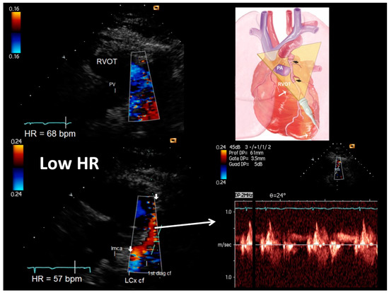Heart Rate Lowering Significantly Increases Feasibility in Doppler ...
