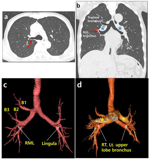 Left Bronchial Isomerism with Right-Sided Tracheal Bronchus: A Rare ...