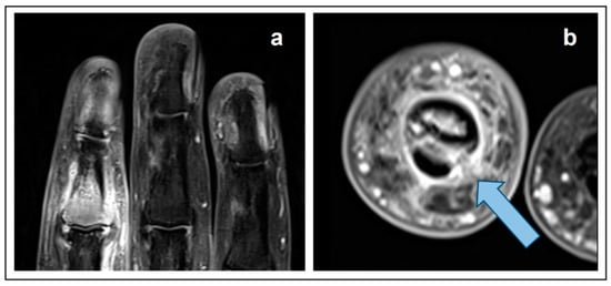 Finger Pain as an Uncommon Primary Manifestation of Lung Carcinoma