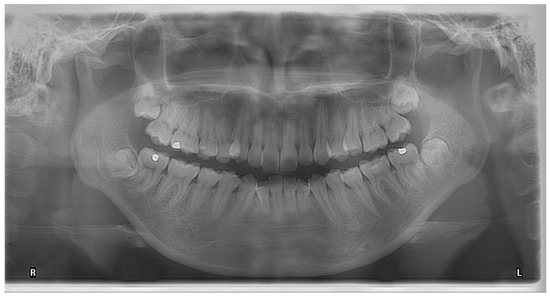 Application of Cone Beam Computed Tomography in Risk Assessment of ...