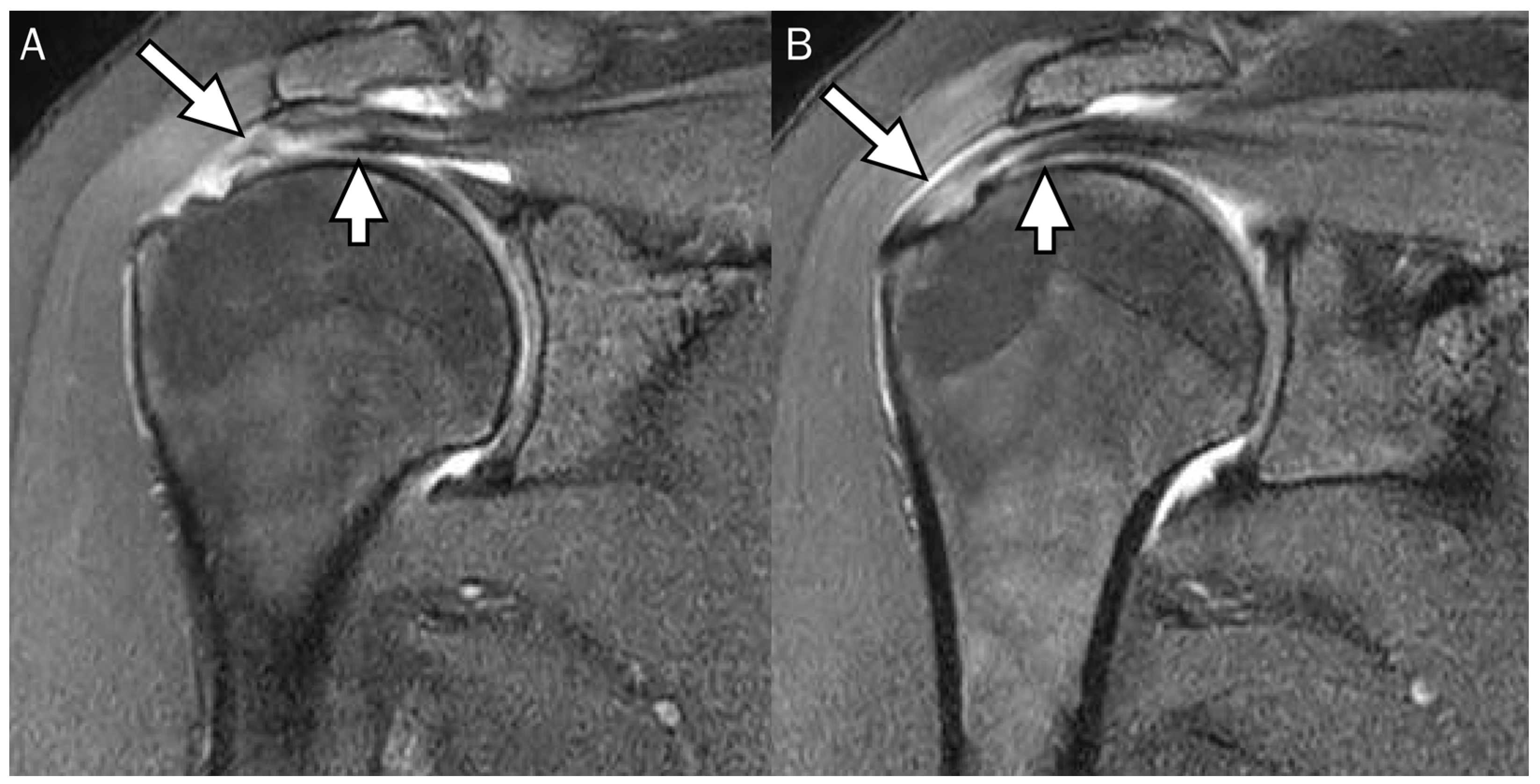 Mri Shoulder Tear Mri Shoulder Tear