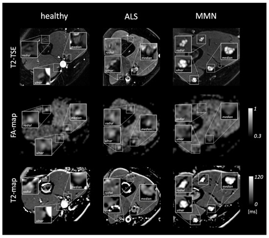 Quantitative MR Neurography in Multifocal Motor Neuropathy and ...