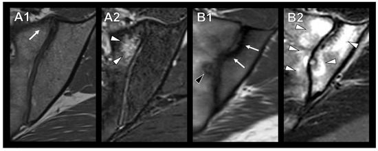 Clustered Occurrence of Osteitis Condensans Ilii in Patients with ...