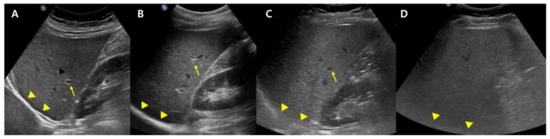 Non-Invasive Imaging Methods to Evaluate Non-Alcoholic Fatty Liver ...