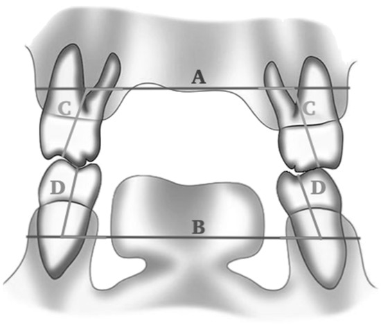 A Correlation Analysis between Arch Width and Molar Inclination Using ...
