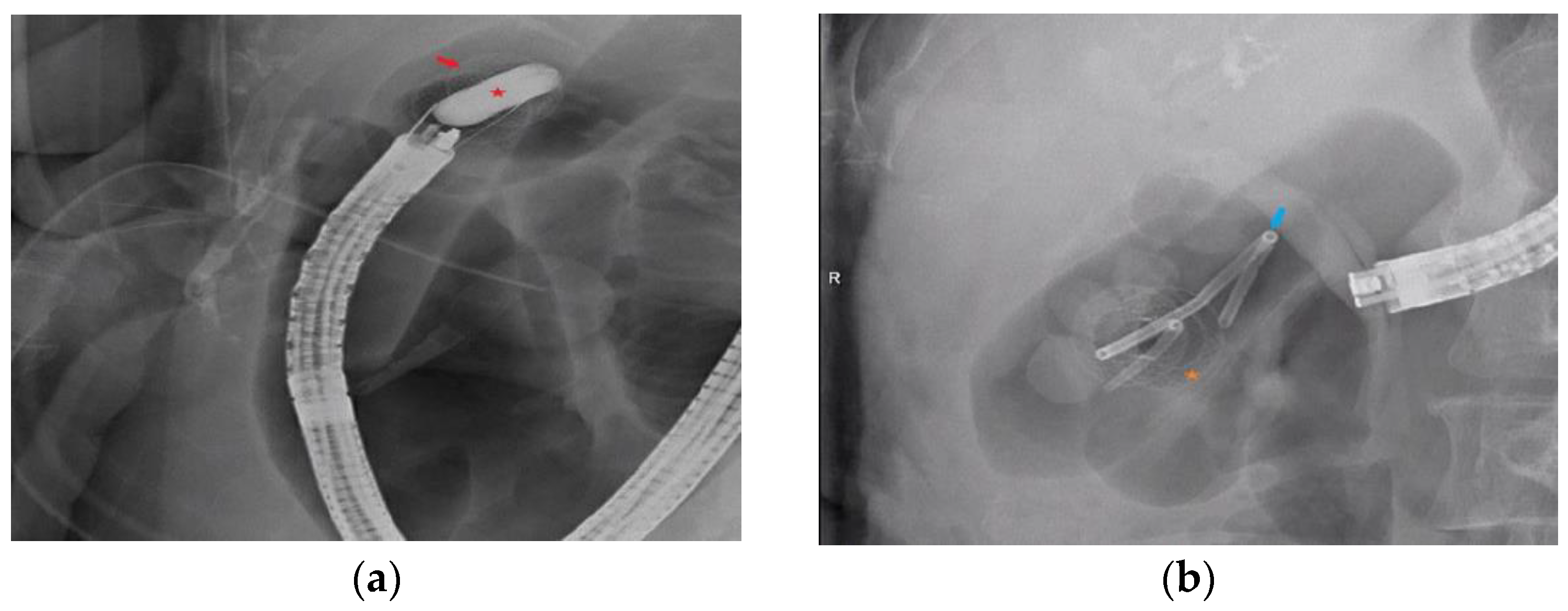 Endoscopic Ultrasound Guided Gallbladder Drainage Beyond Cholecystitis Endoscopic Ultrasound Guided Gallbladder Drainage Beyond Cholecystitis