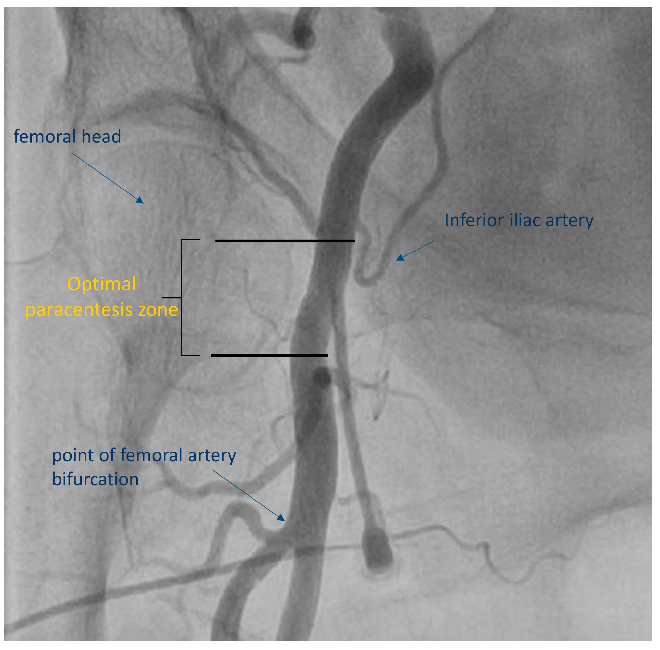 Femoral Pulse Landmark Femoral Pulse Landmark