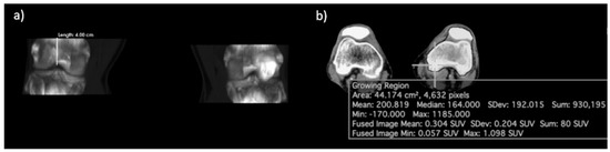 18F-FDG and 18F-NaF PET/CT Global Assessment of Large Joint ...