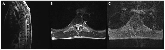 Progressive Lower Extremity Paralysis Caused by Intrathecal MTX-Induced ...