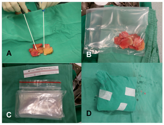 Exploring the Role of Intraoperative Positive Culture of Allograft Bone ...