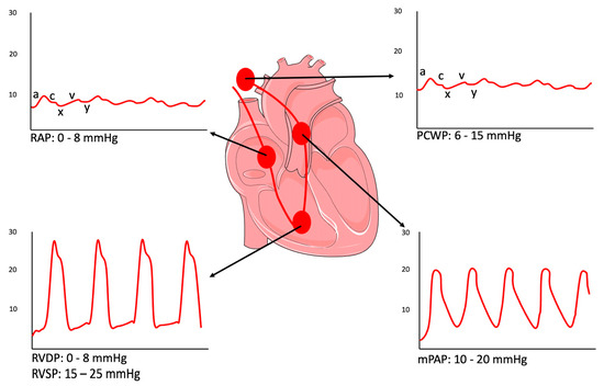 Contemporary Evidence and Practice on Right Heart Catheterization in ...