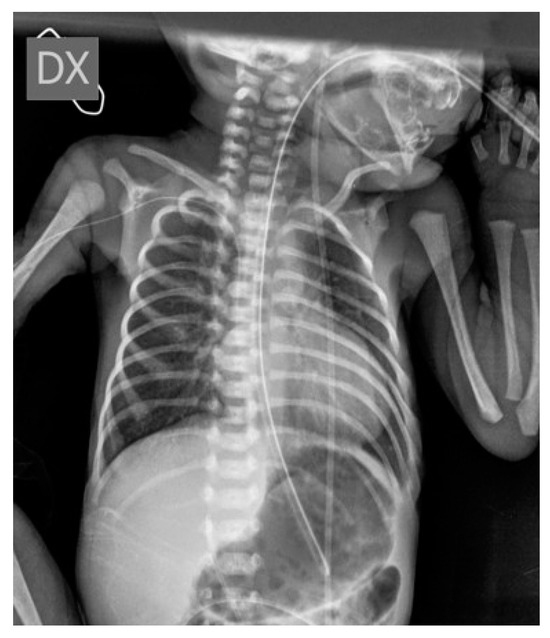 Conventional Radiology Evaluation of Neonatal Intravascular Devices ...