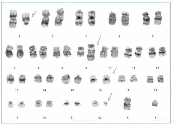 Novel Four-Way Variant Translocation, t(1;9;22;16)(q21;q34;q11.2;q24), in a Patient with Chronic ...