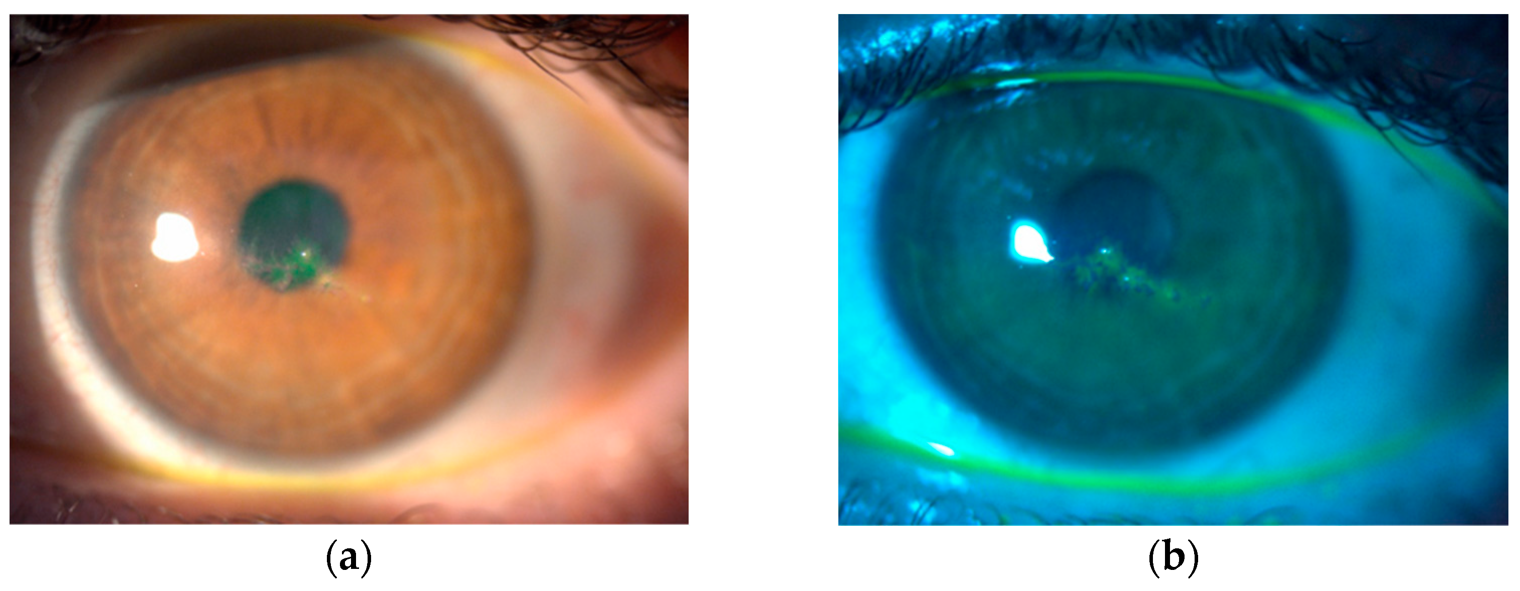 Keratitis Keratitis