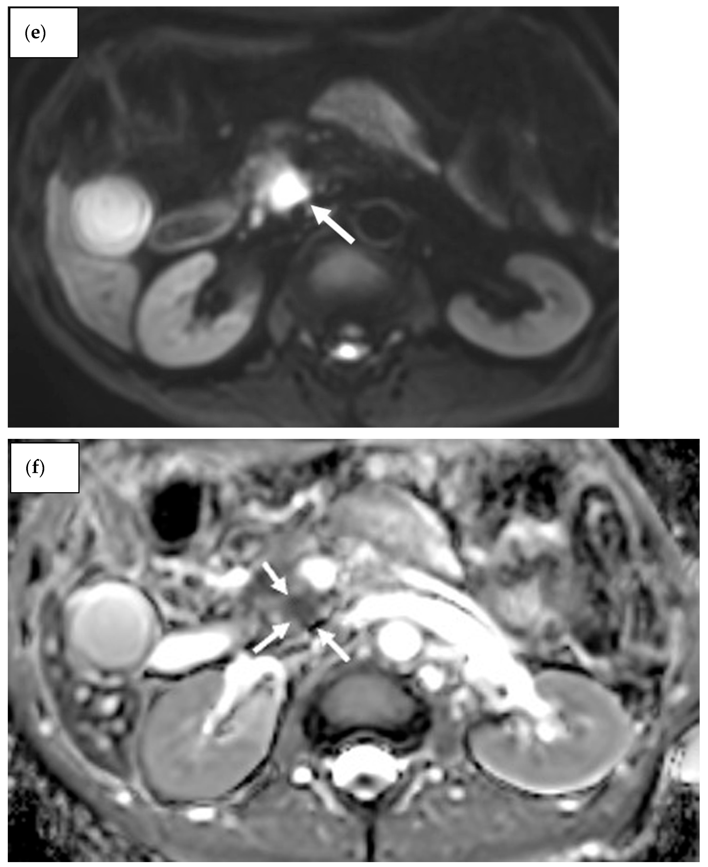Effective Extracellular Volume Fraction Determined by Equilibrium ...
