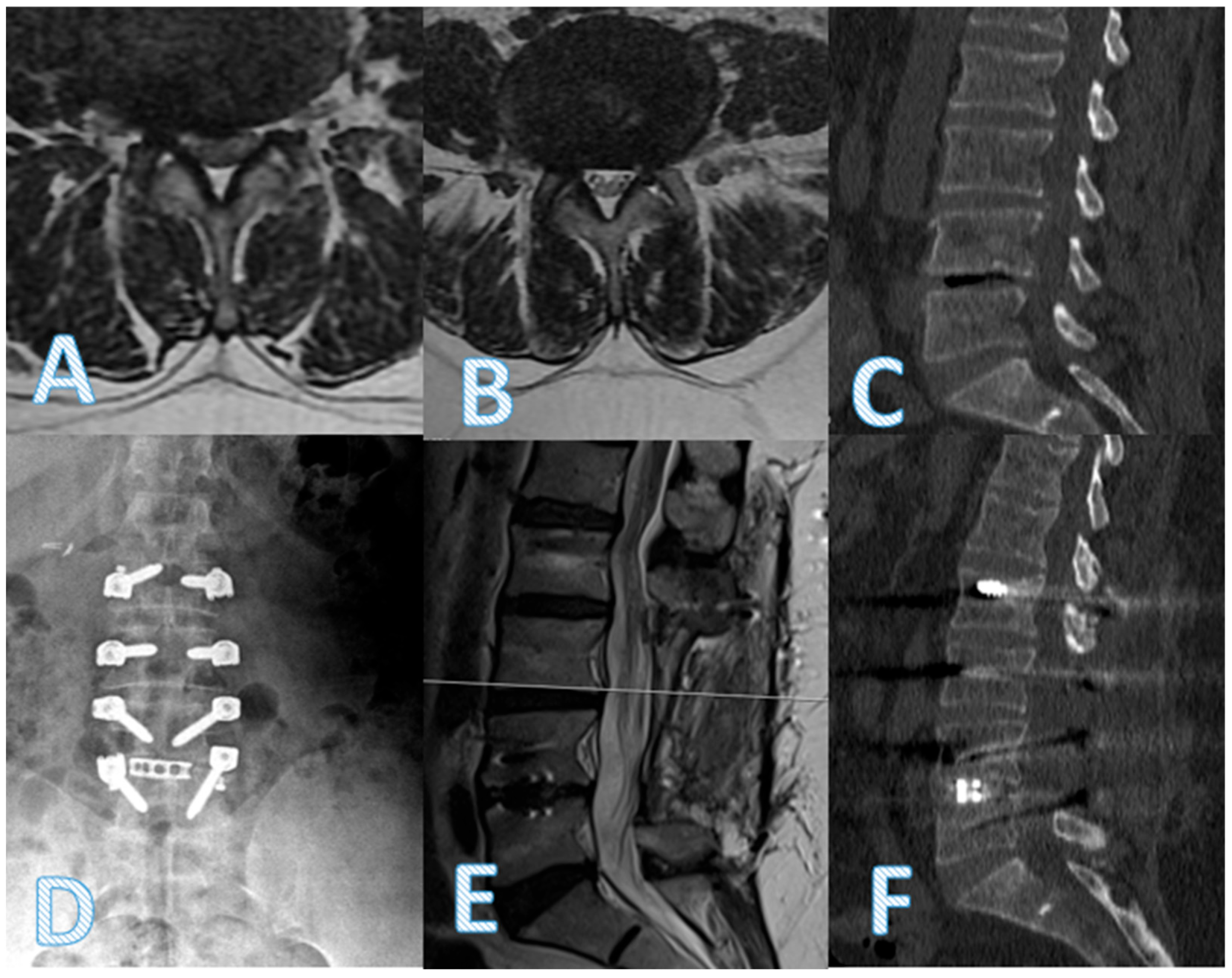 Comparison of Hybrid Dynamic Stabilization with TLIF Versus Dynamic ...