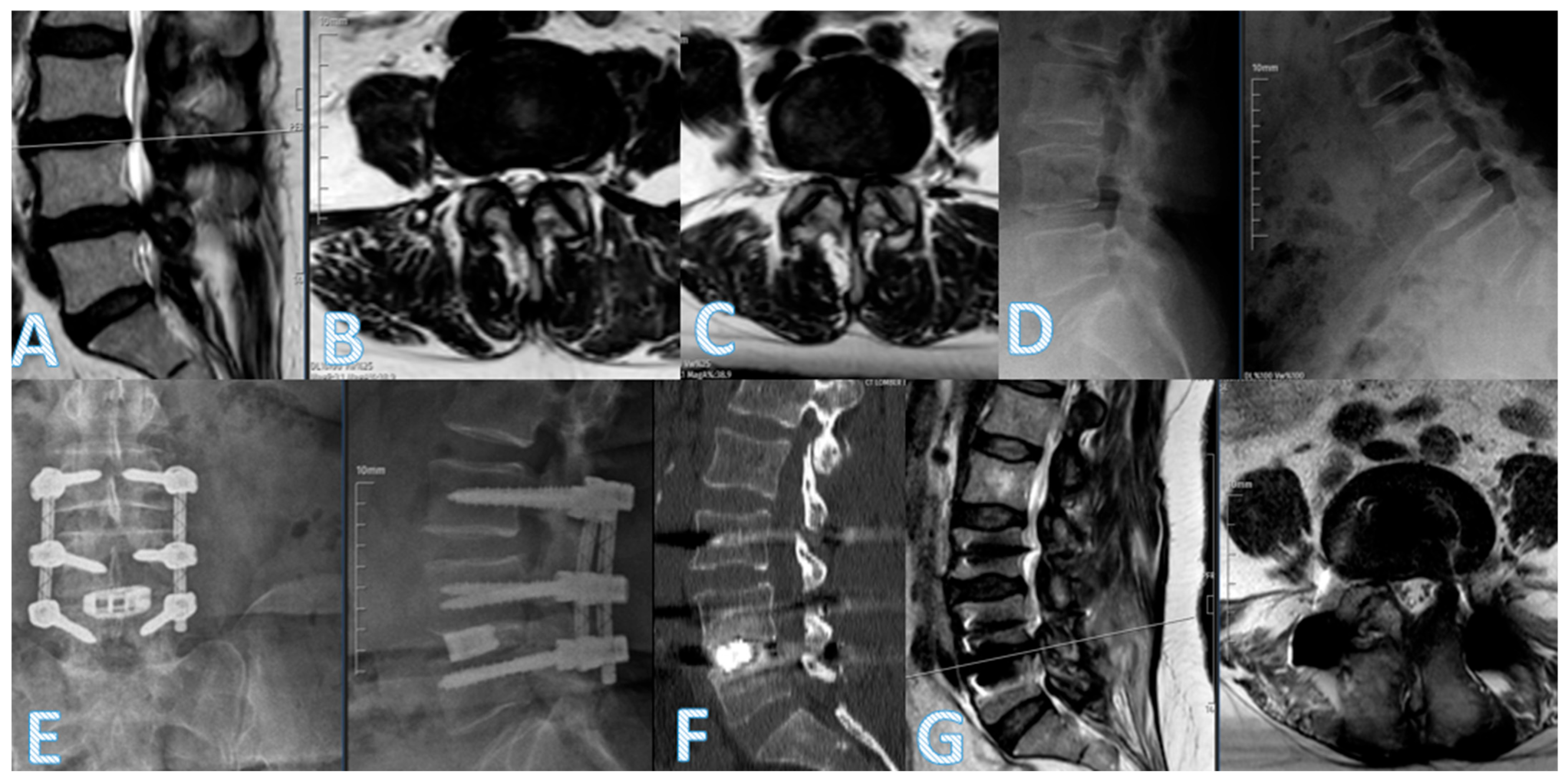 Comparison of Hybrid Dynamic Stabilization with TLIF Versus Dynamic Stabilization Alone in ...