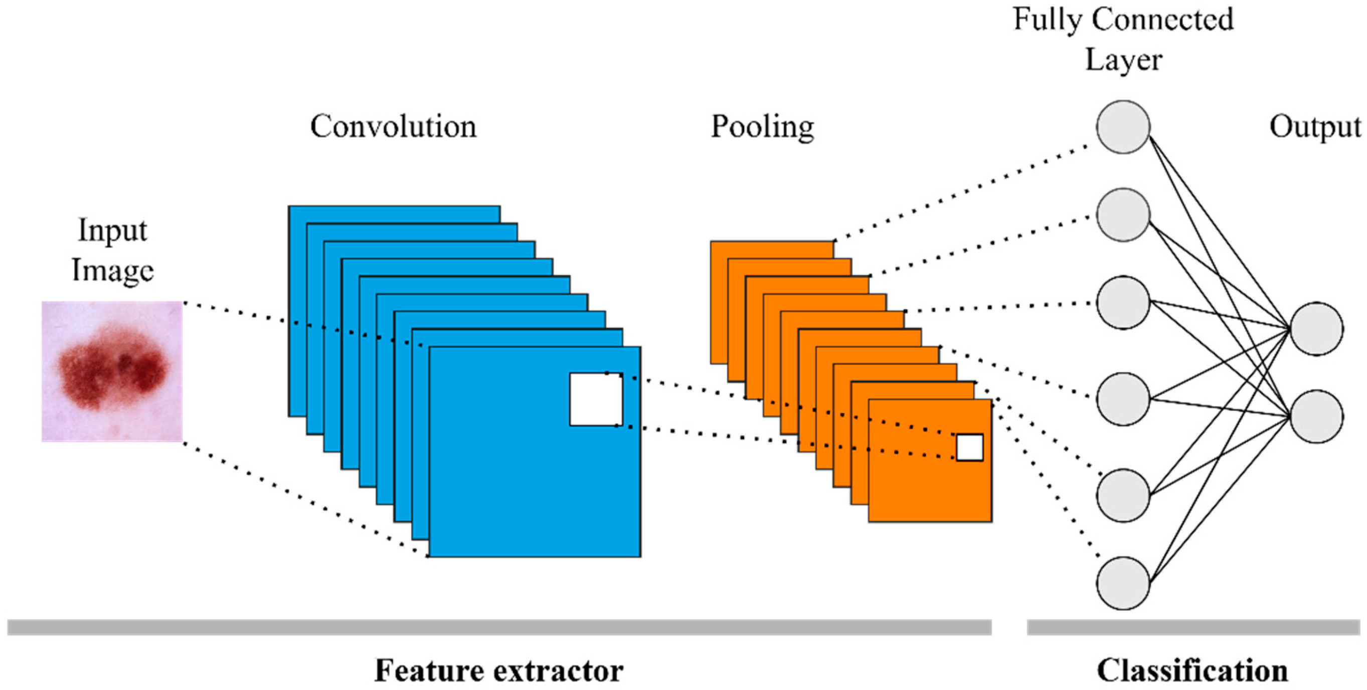 Transfer Learning-Based Ensemble of CNNs and Vision Transformers for Accurate Melanoma Diagnosis ...