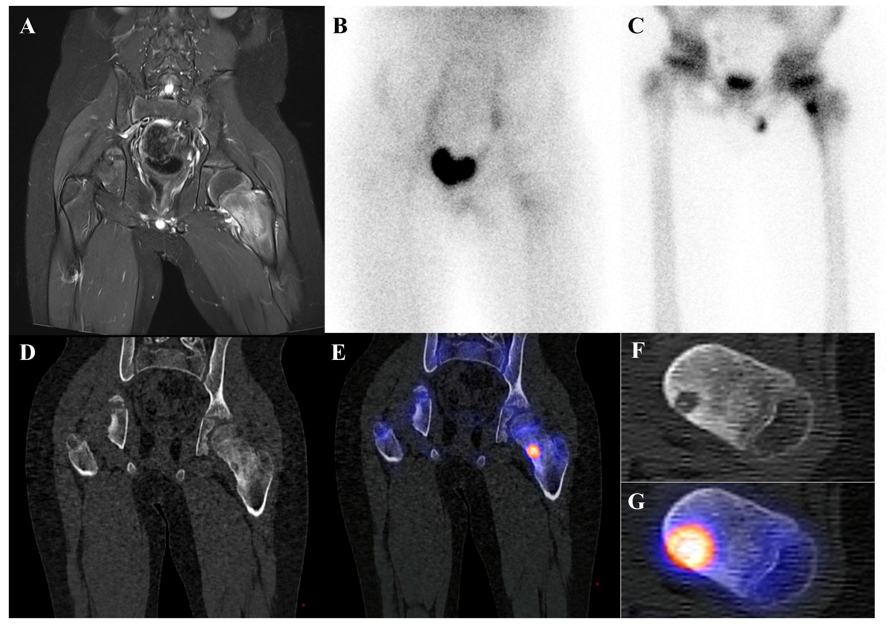 Current Position of Nuclear Medicine Imaging in Primary Bone Tumors