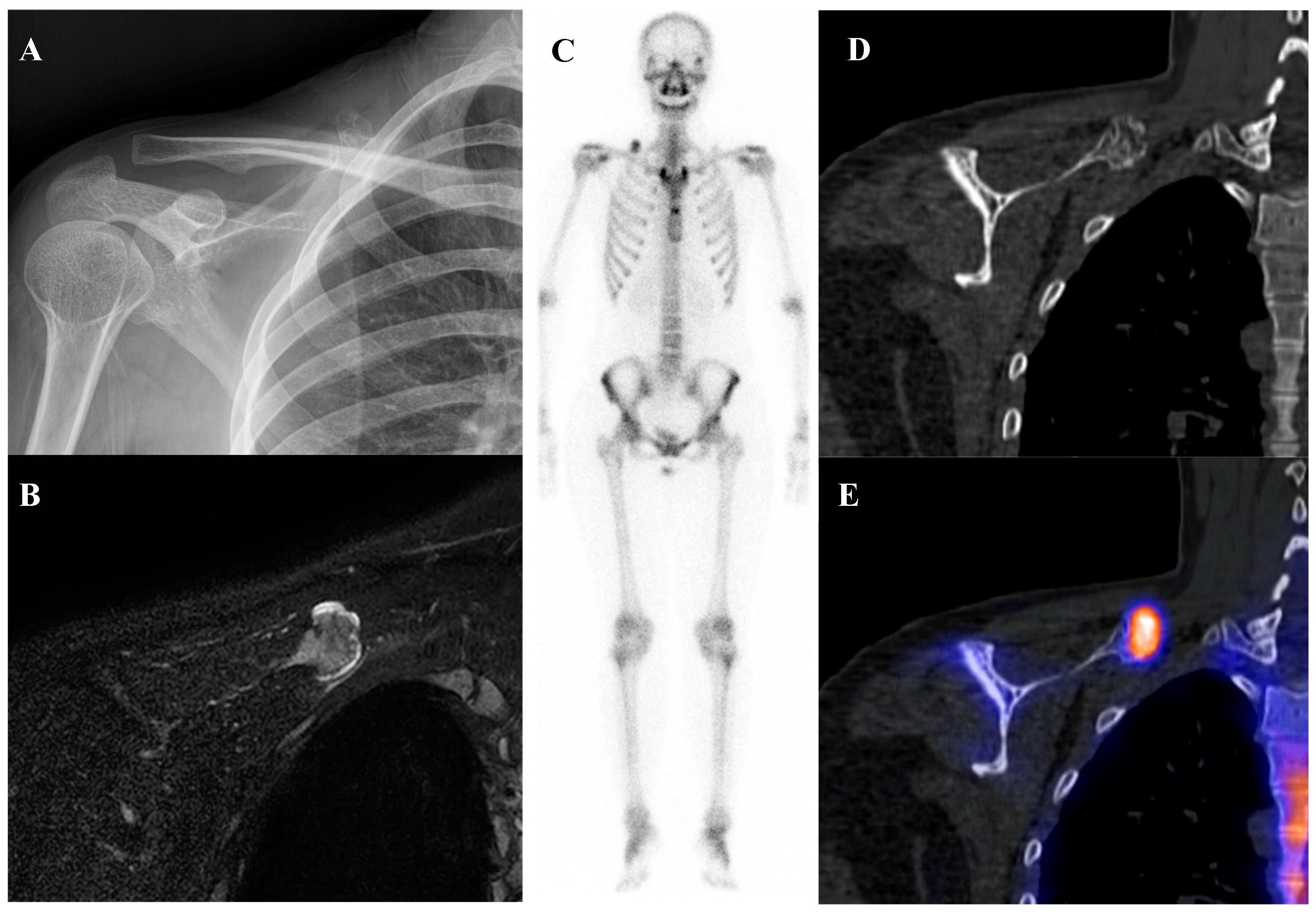 Current Position of Nuclear Medicine Imaging in Primary Bone Tumors