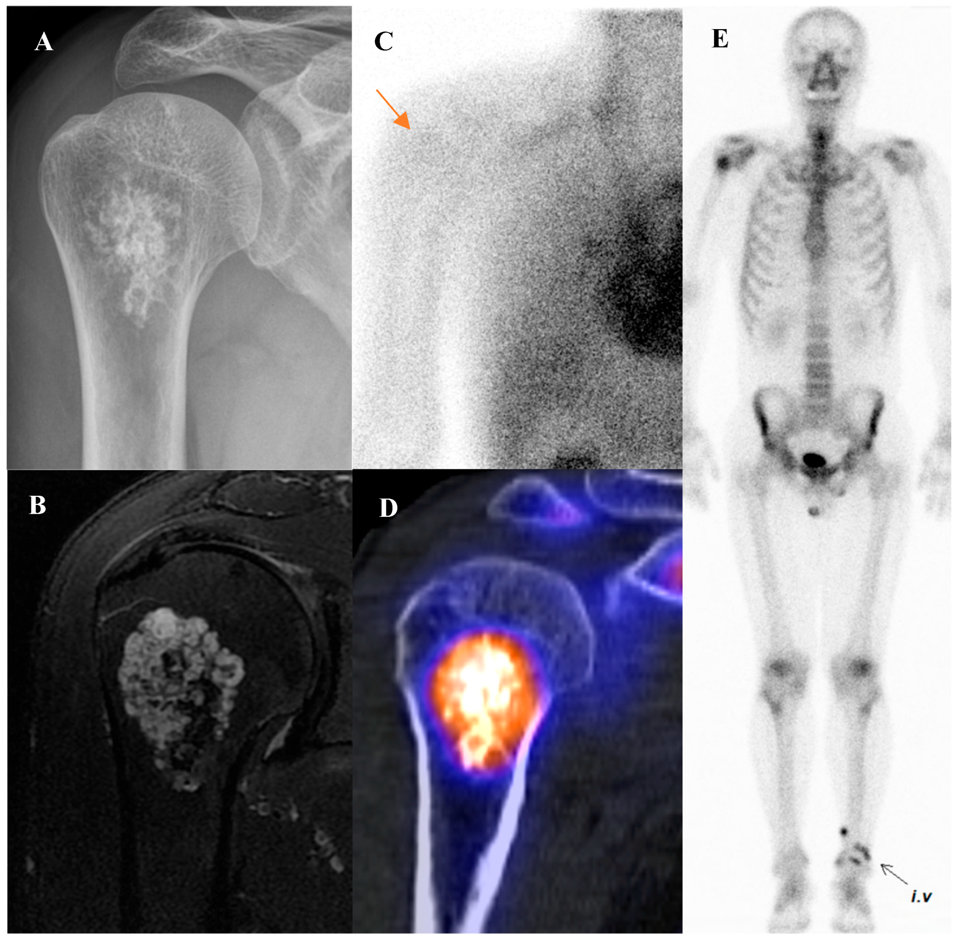 Current Position of Nuclear Medicine Imaging in Primary Bone Tumors