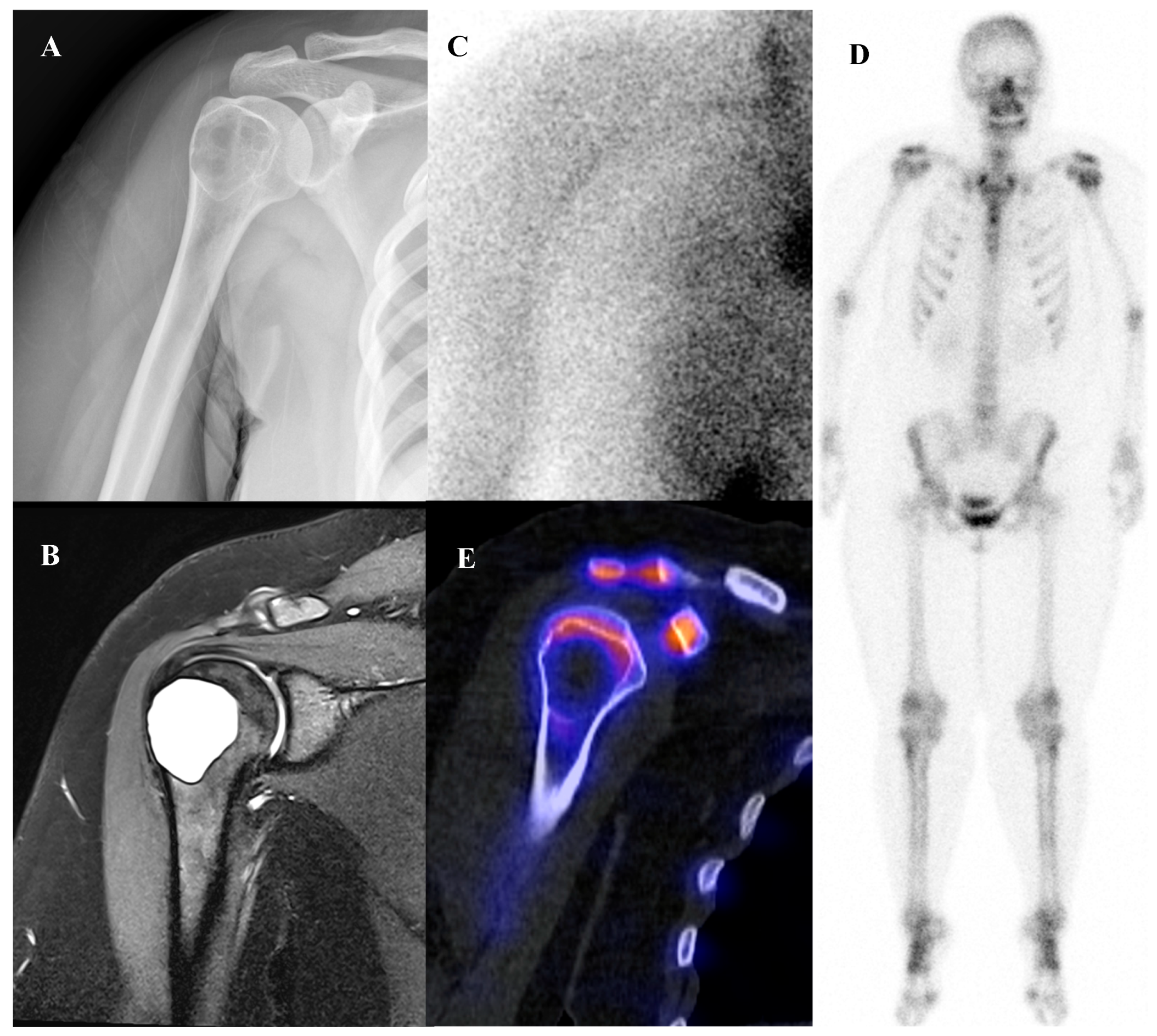 Current Position of Nuclear Medicine Imaging in Primary Bone Tumors