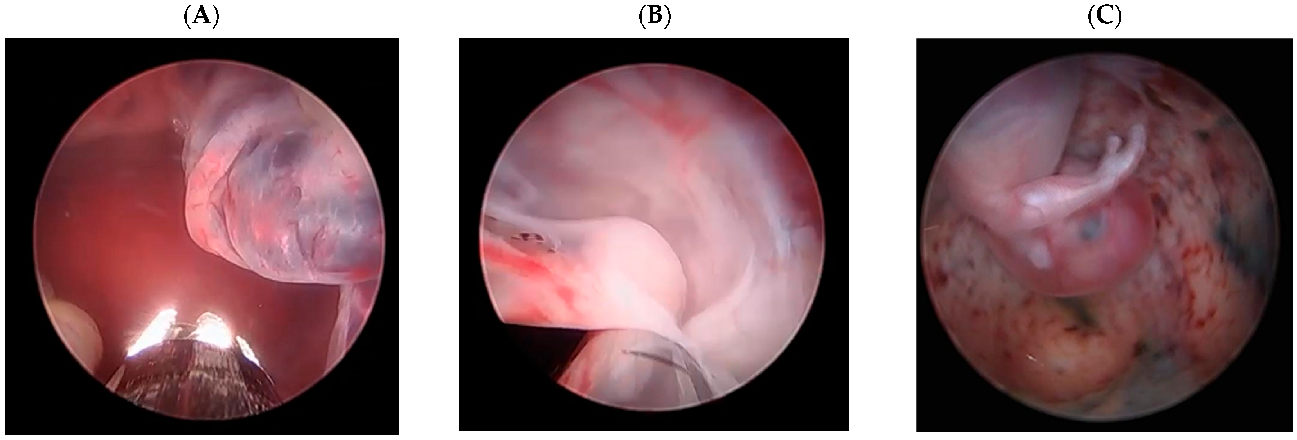 Single-Session No-Touch Hysteroscopic Mechanical Resection for Cesarean ...