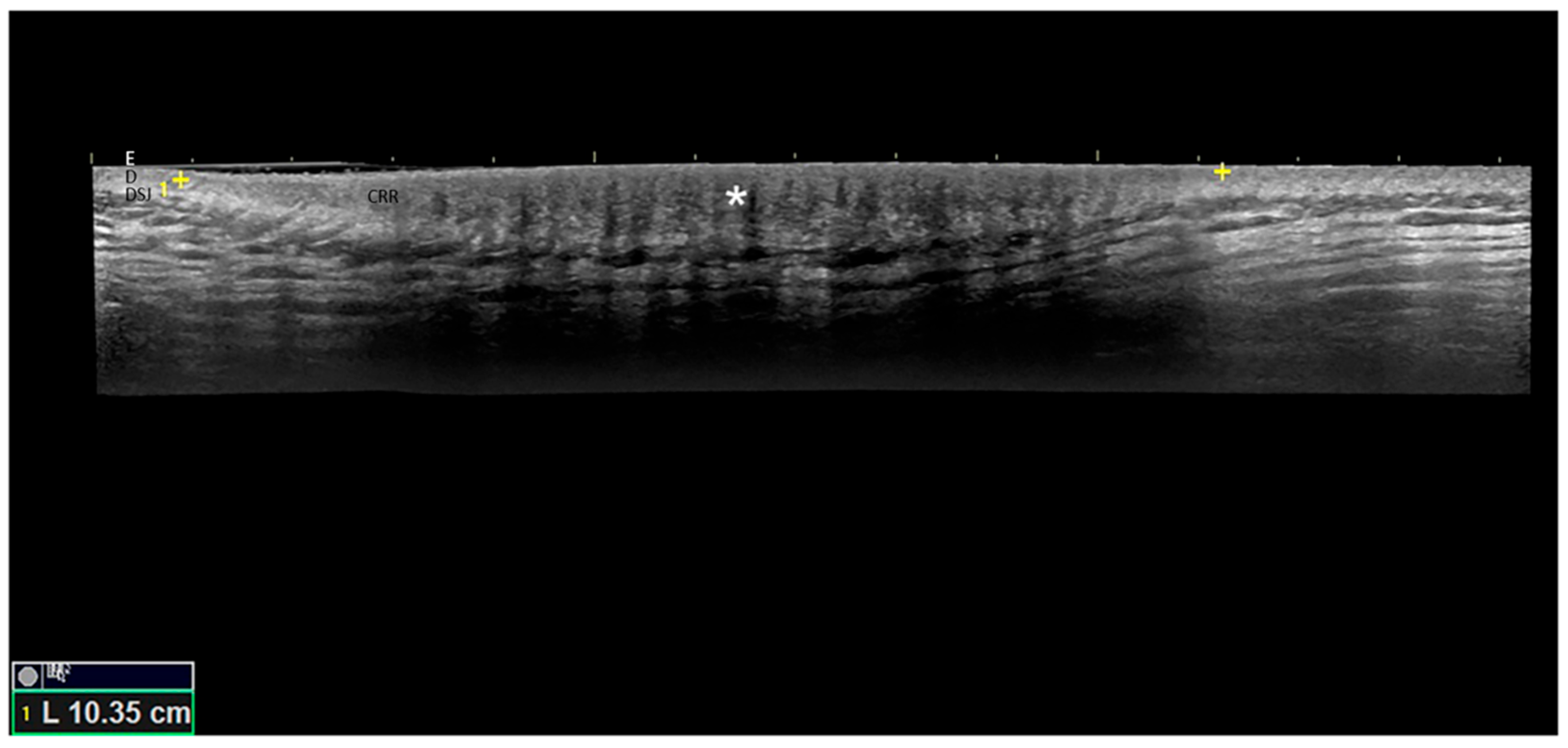 Shagreen Patch in Tuberous Sclerosis Complex at High-Frequency Ultrasound