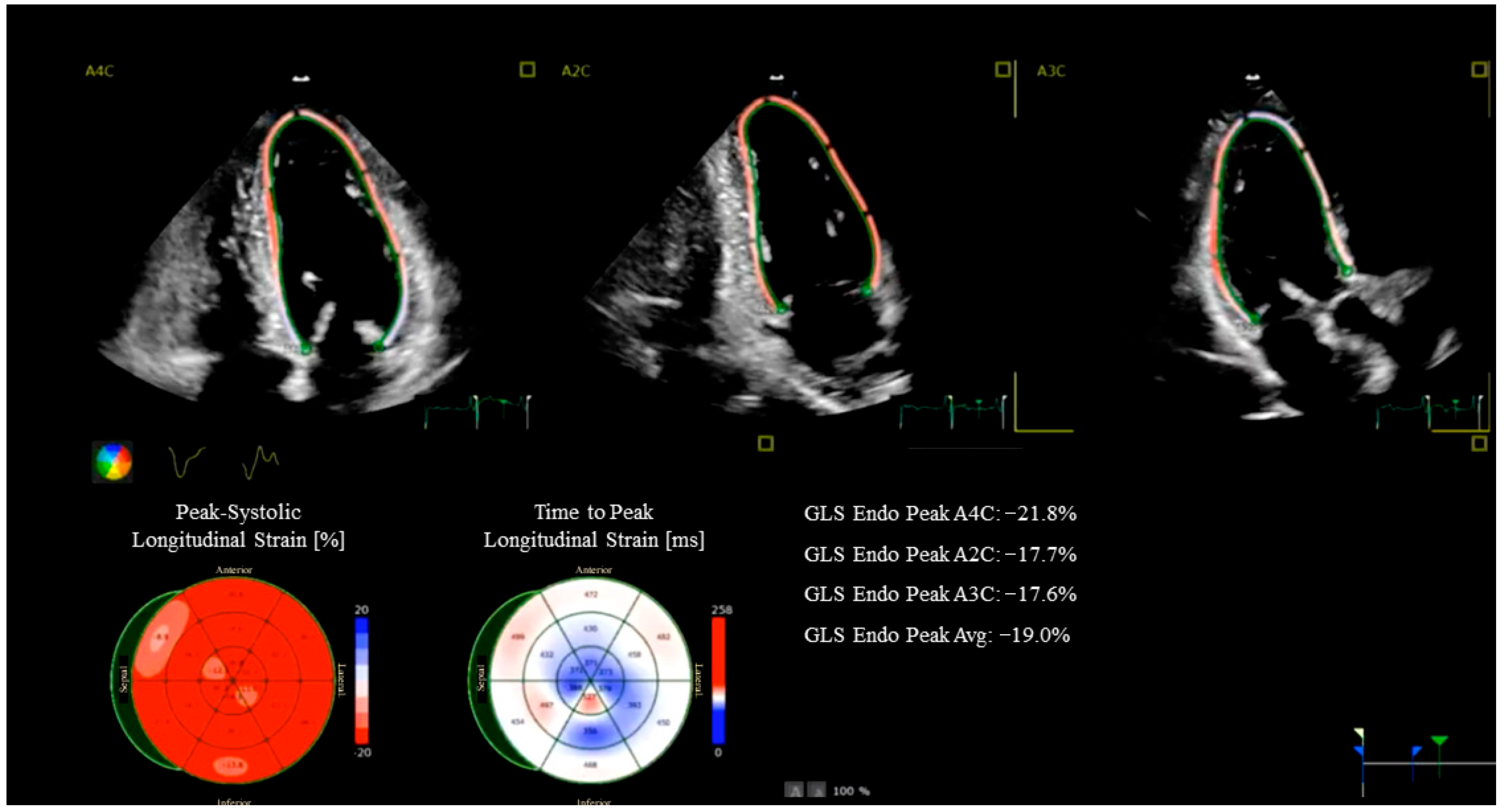 Multimodality Cardiovascular Imaging in Patients After Coronary Artery Bypass Grafting ...