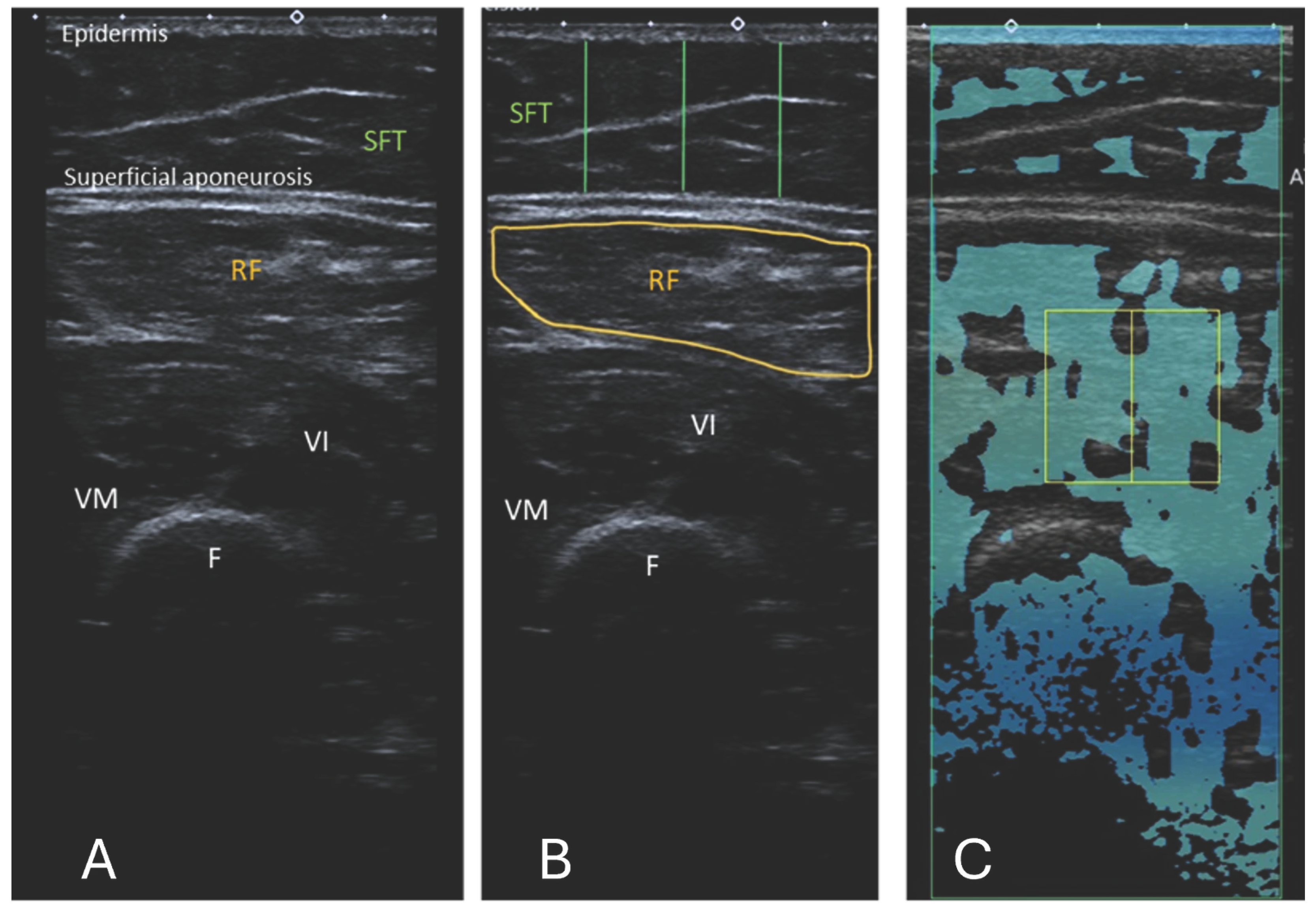 Comparison of Attenuation Imaging in the Rectus Femoris and Biceps ...