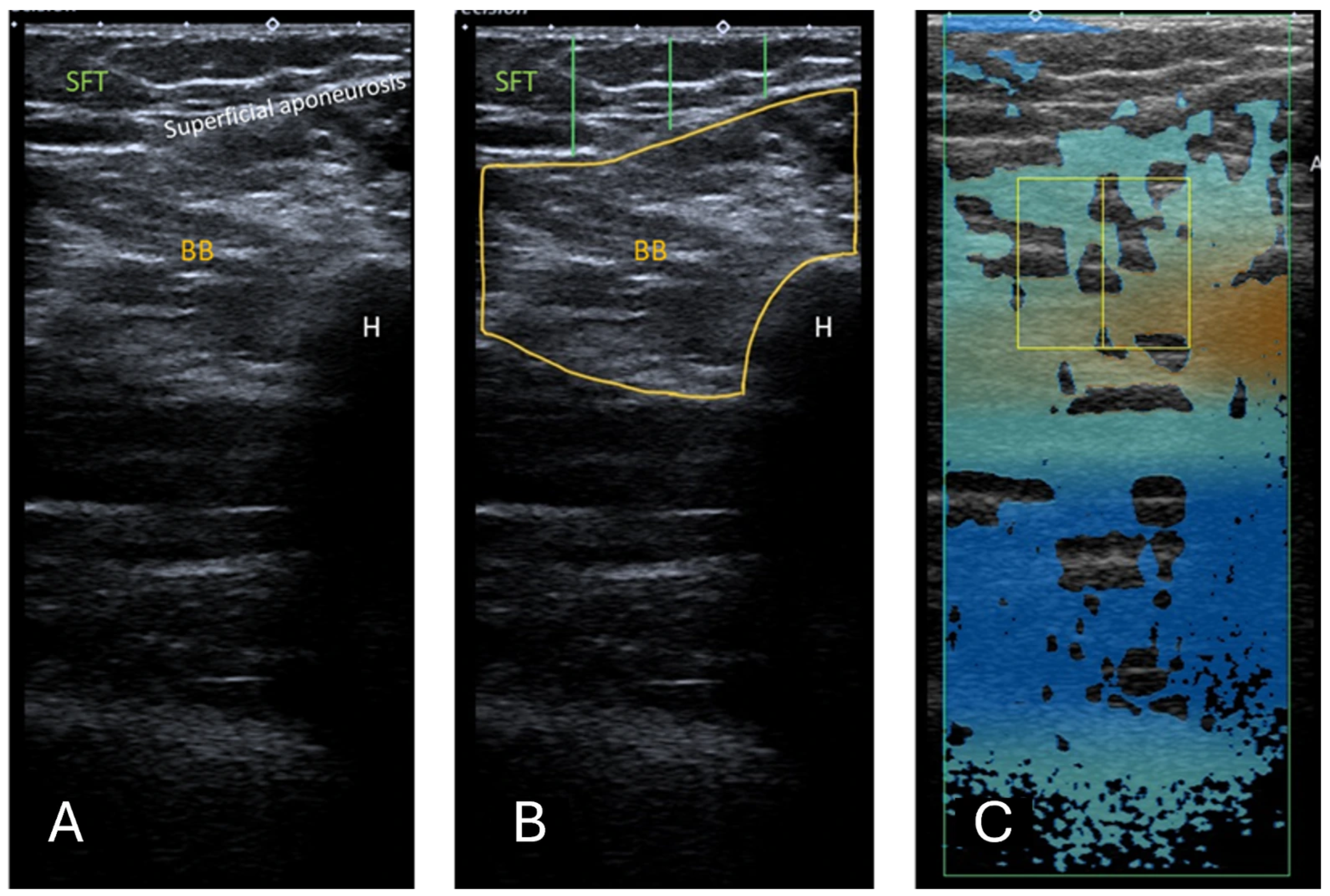 Comparison of Attenuation Imaging in the Rectus Femoris and Biceps ...