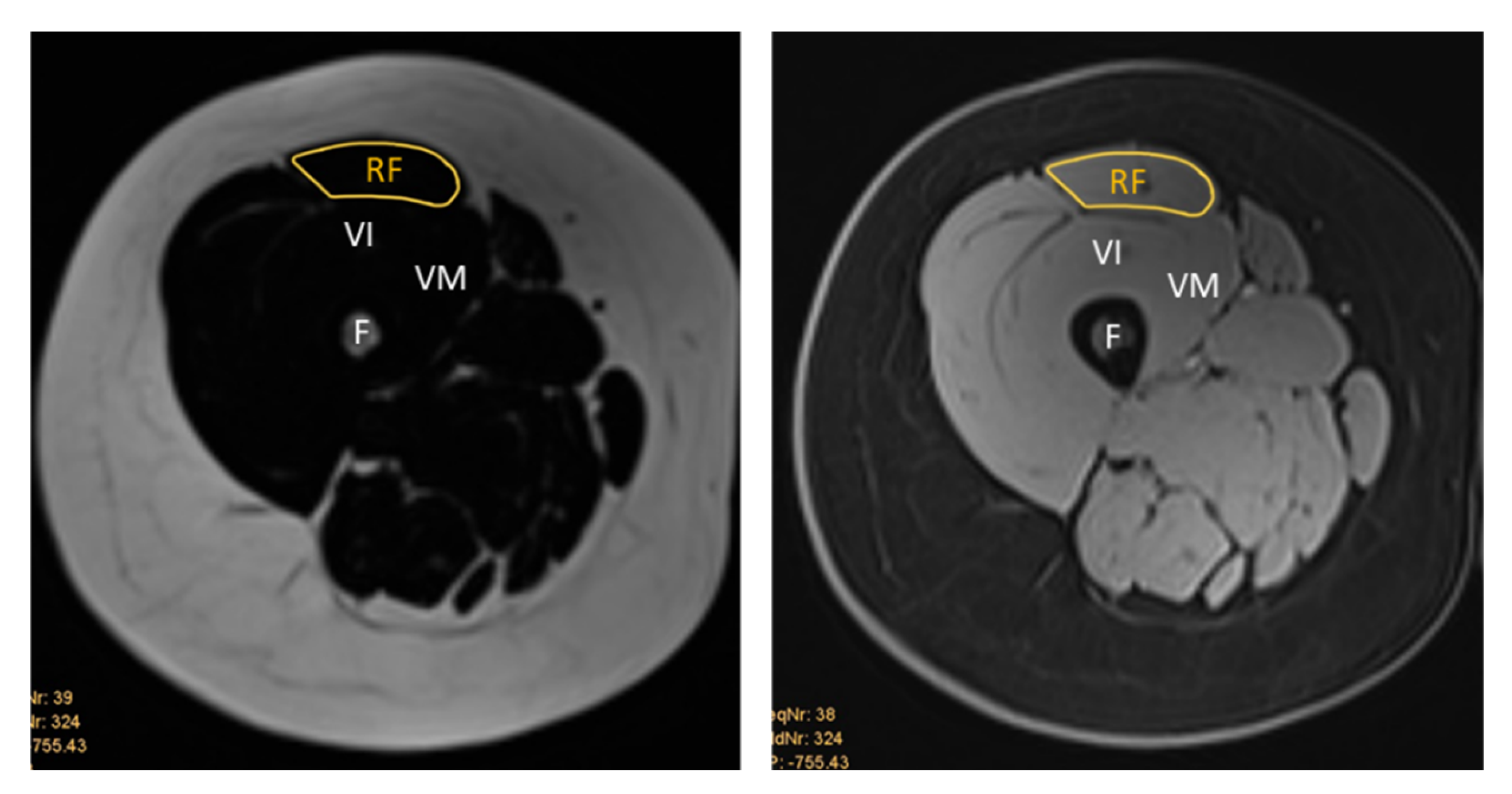 Comparison of Attenuation Imaging in the Rectus Femoris and Biceps ...