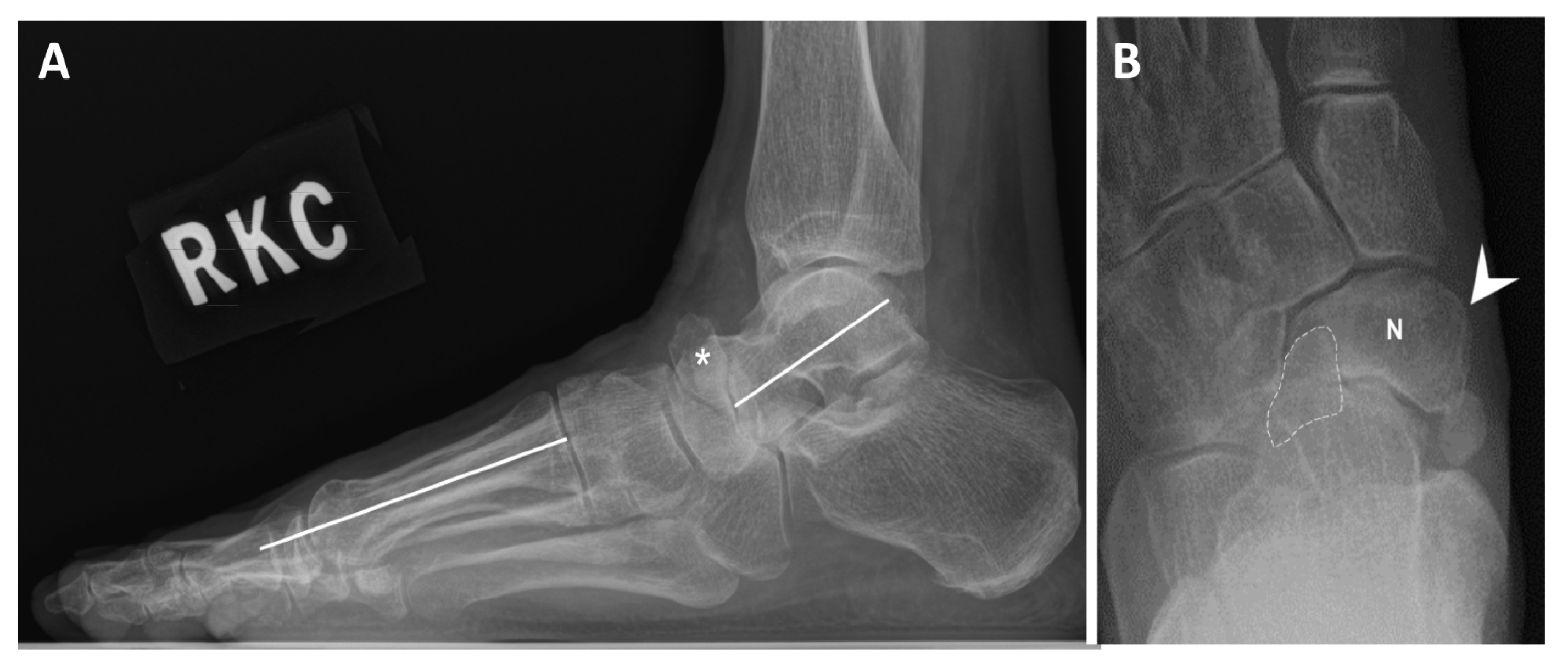 Utility of Quantitative and Semi-Quantitative SPECT/CT Metrics in ...