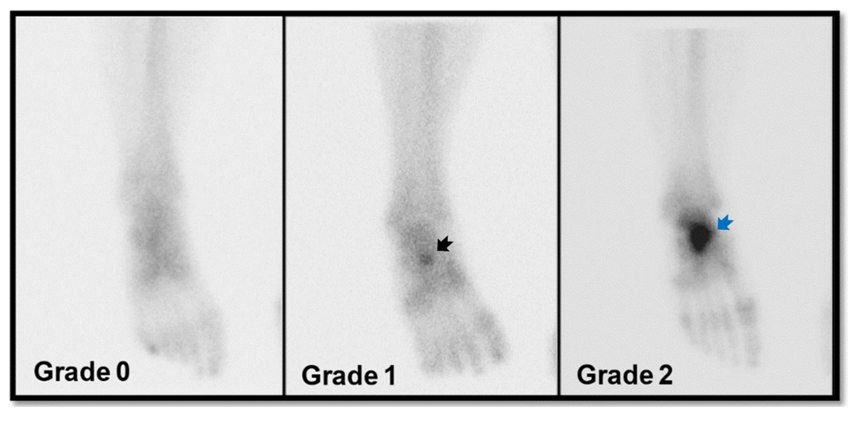 Utility of Quantitative and Semi-Quantitative SPECT/CT Metrics in ...