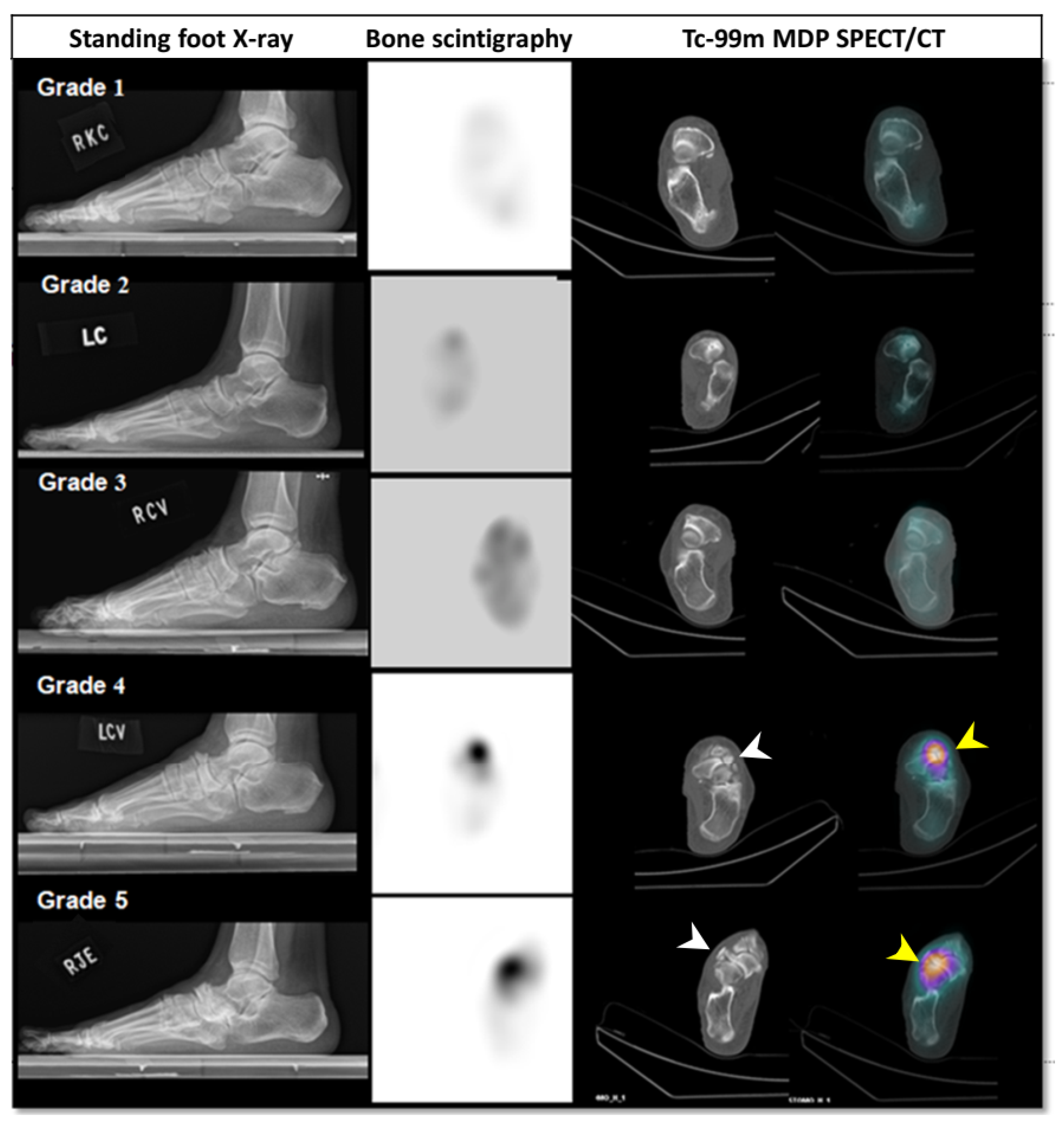 Utility of Quantitative and Semi-Quantitative SPECT/CT Metrics in ...