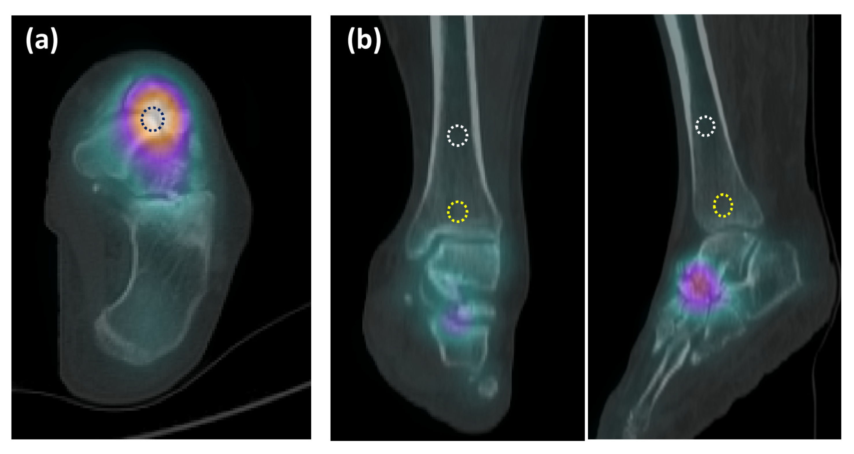 Utility of Quantitative and Semi-Quantitative SPECT/CT Metrics in ...
