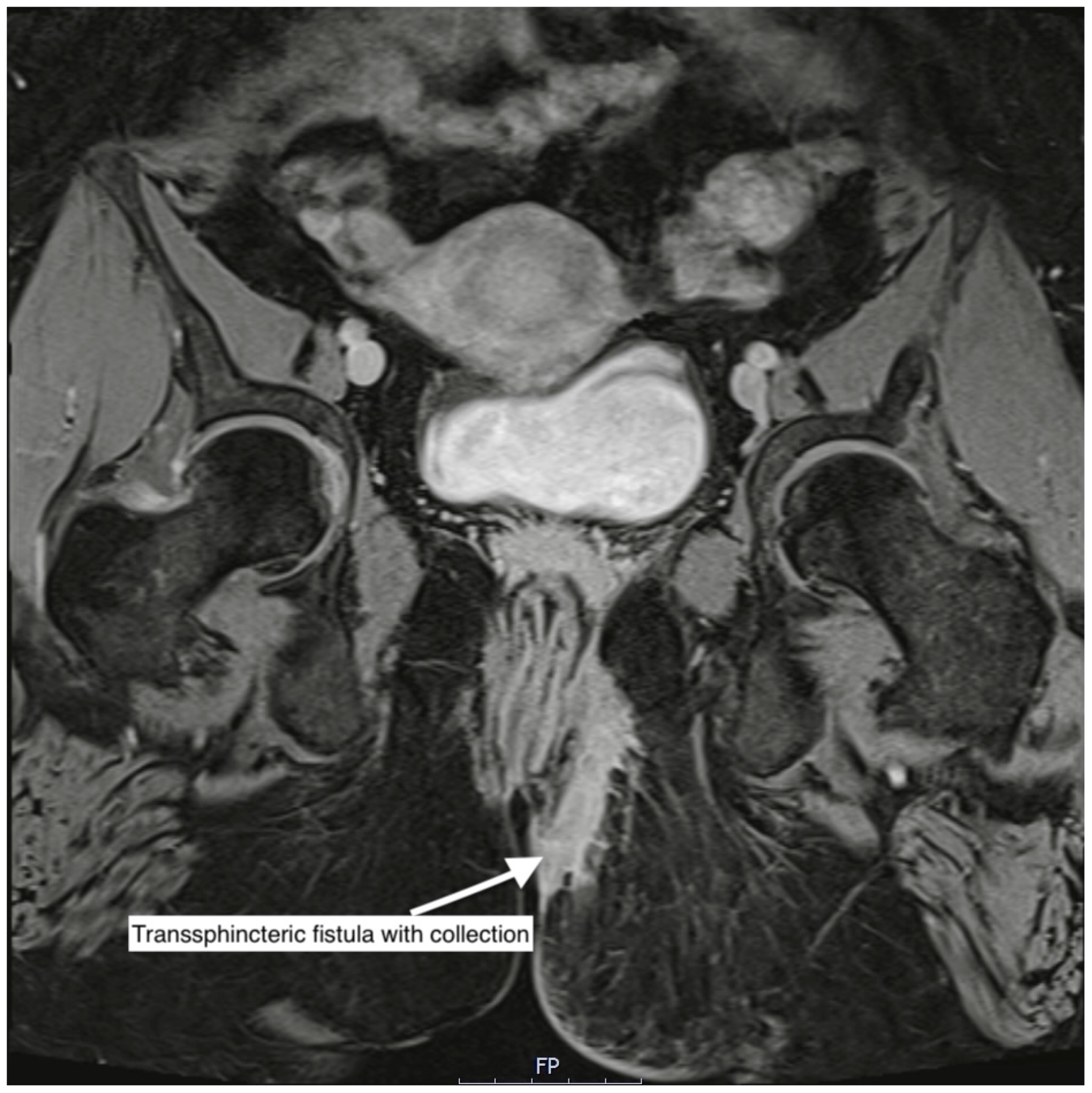 Enhancing Patient Understanding of Perianal Fistula MRI Findings Using ...