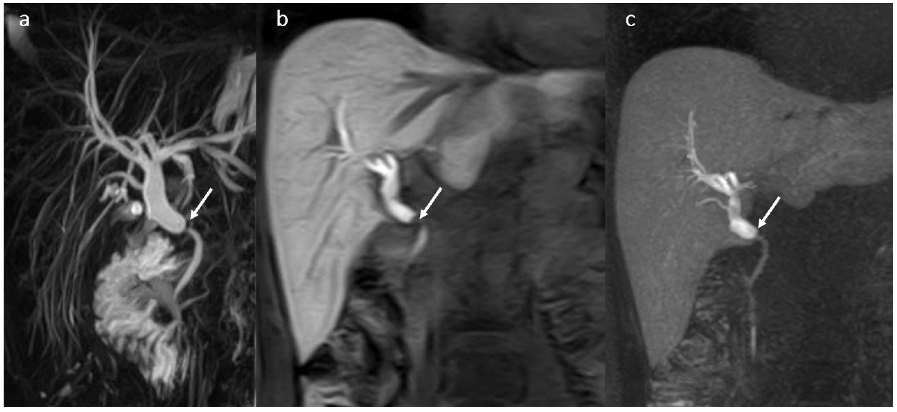 All About Multiparametric MRI Evaluation in Biliary Tree Complications ...