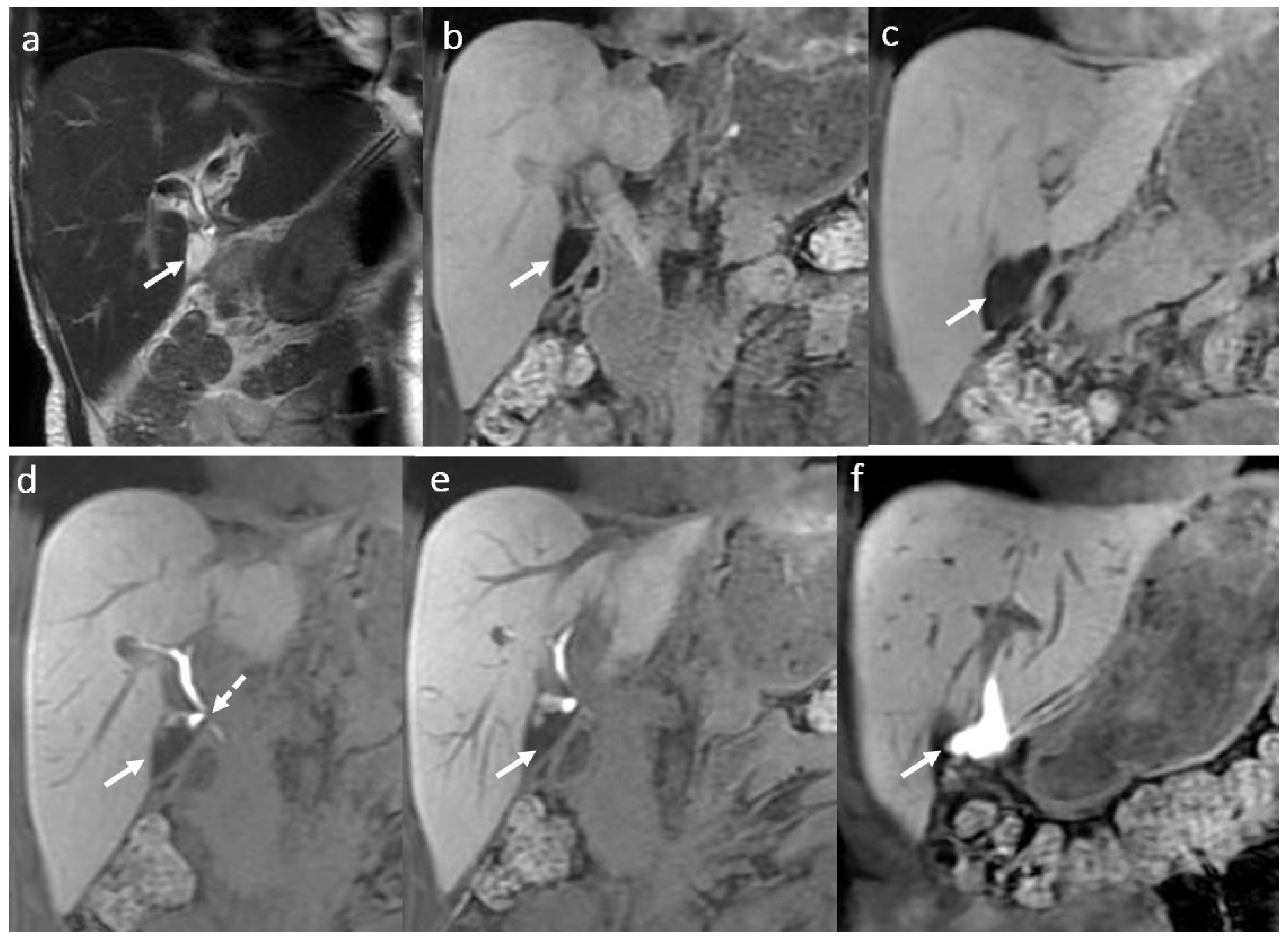 All About Multiparametric MRI Evaluation in Biliary Tree Complications ...
