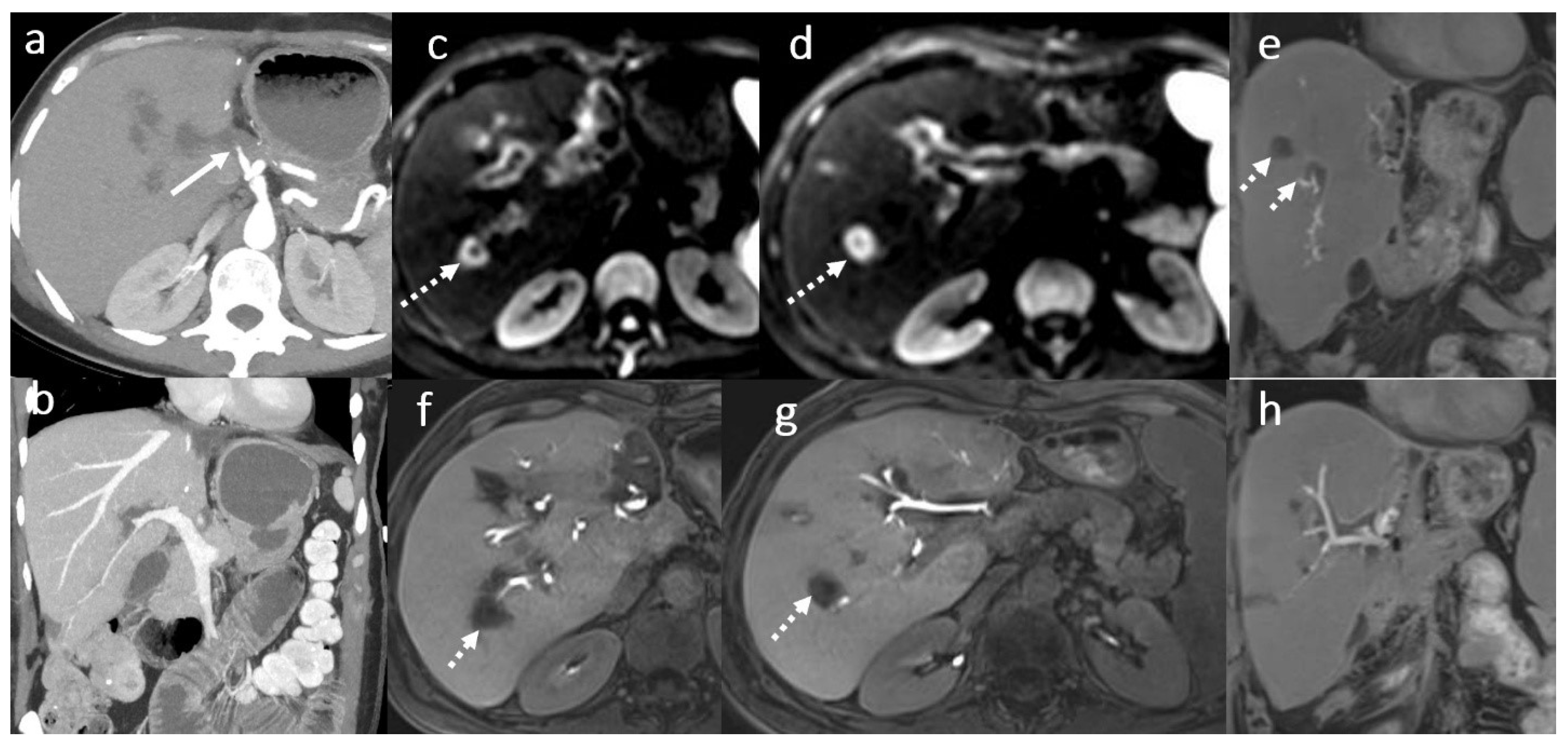 All About Multiparametric MRI Evaluation in Biliary Tree Complications ...