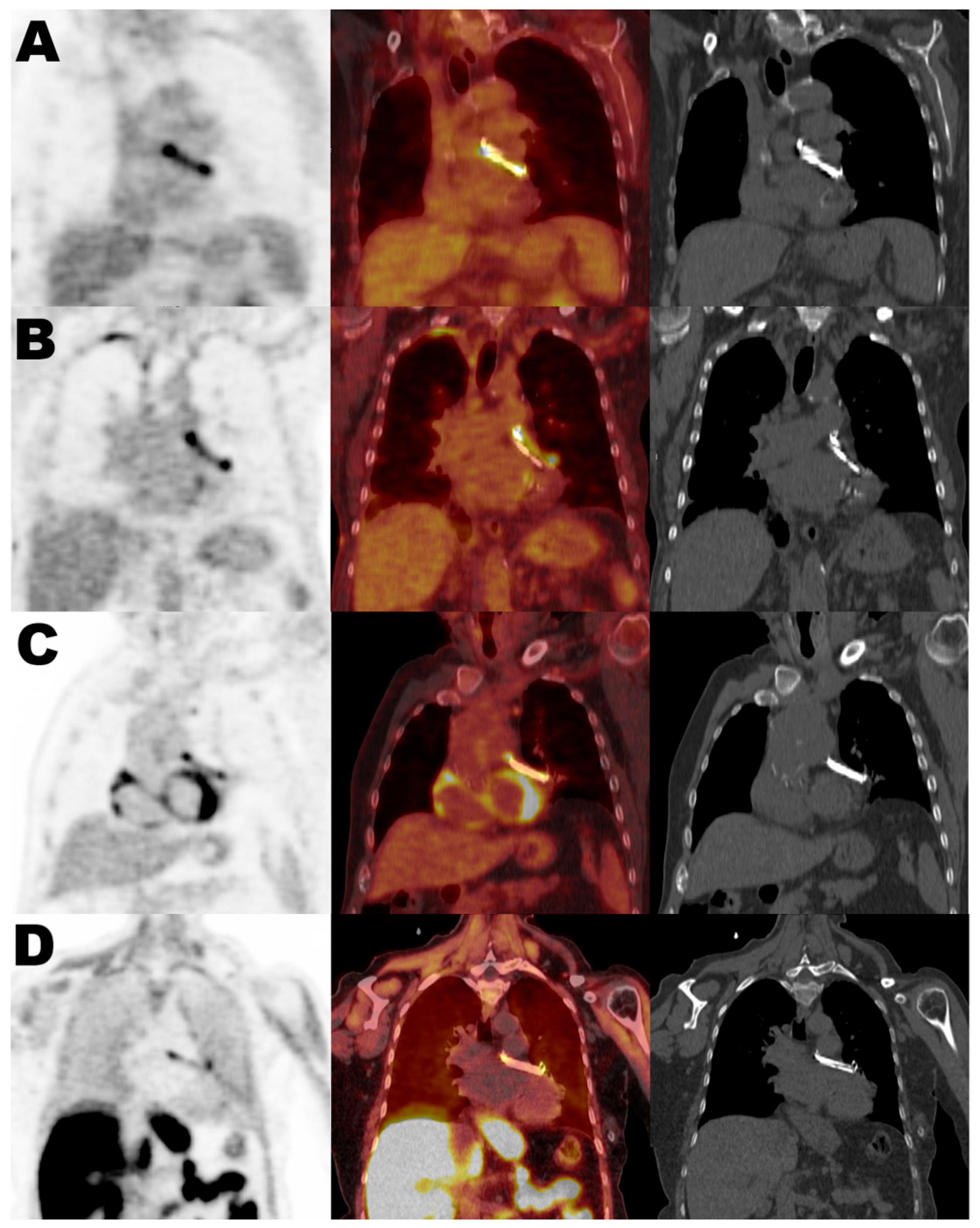 False-Positive PET Uptake in Left Atrial Appendage Closure Devices Due ...