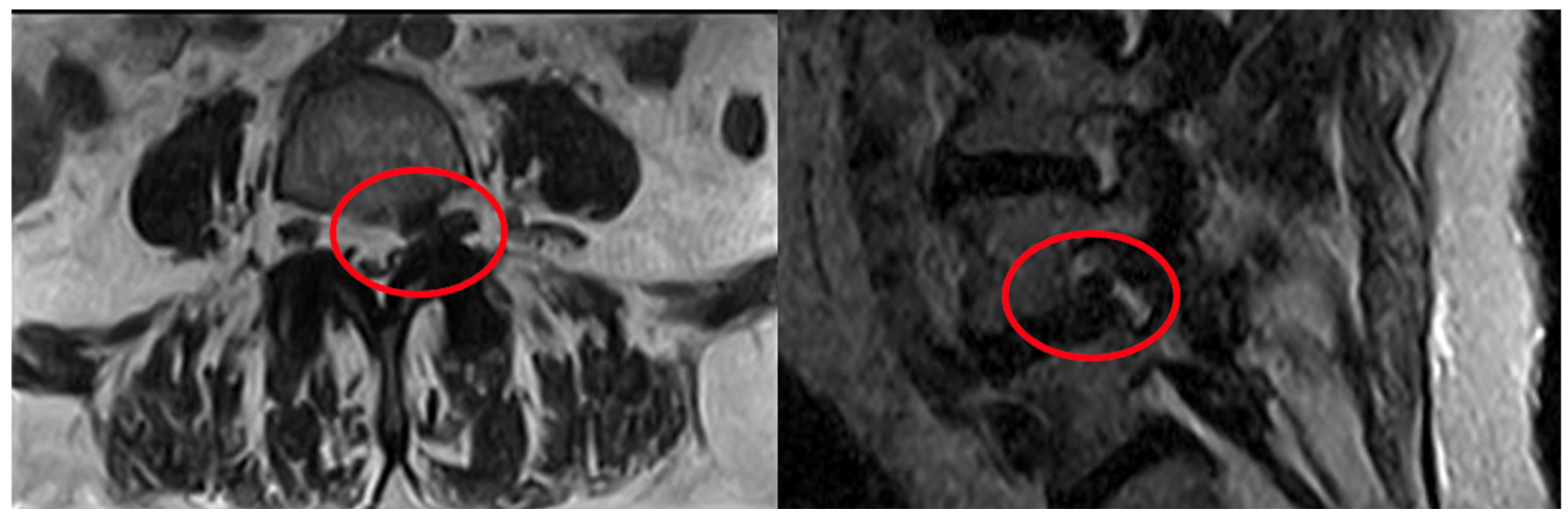 Subacute and Chronic Low-Back Pain: From MRI Phenotype to Imaging ...