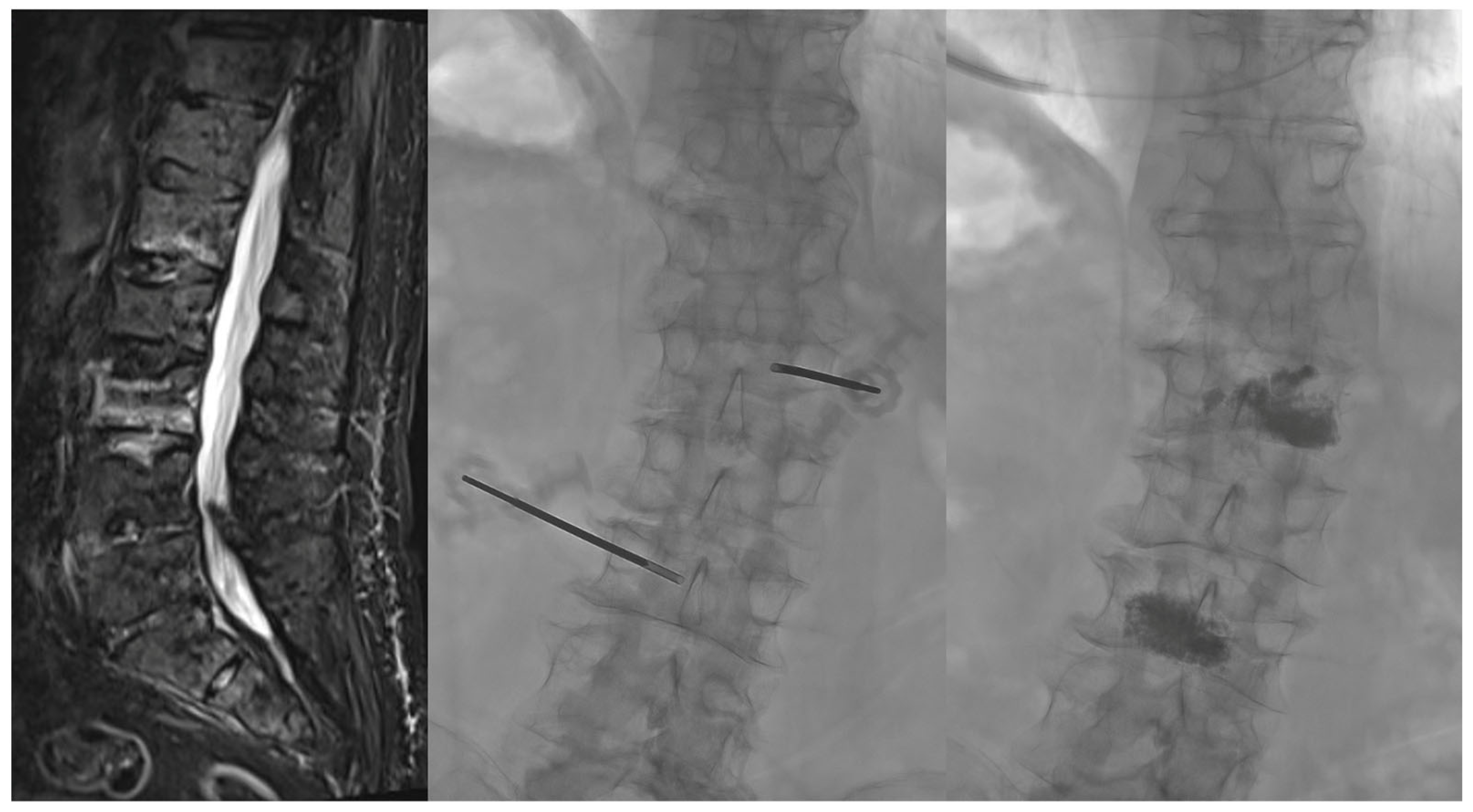 Subacute and Chronic Low-Back Pain: From MRI Phenotype to Imaging ...