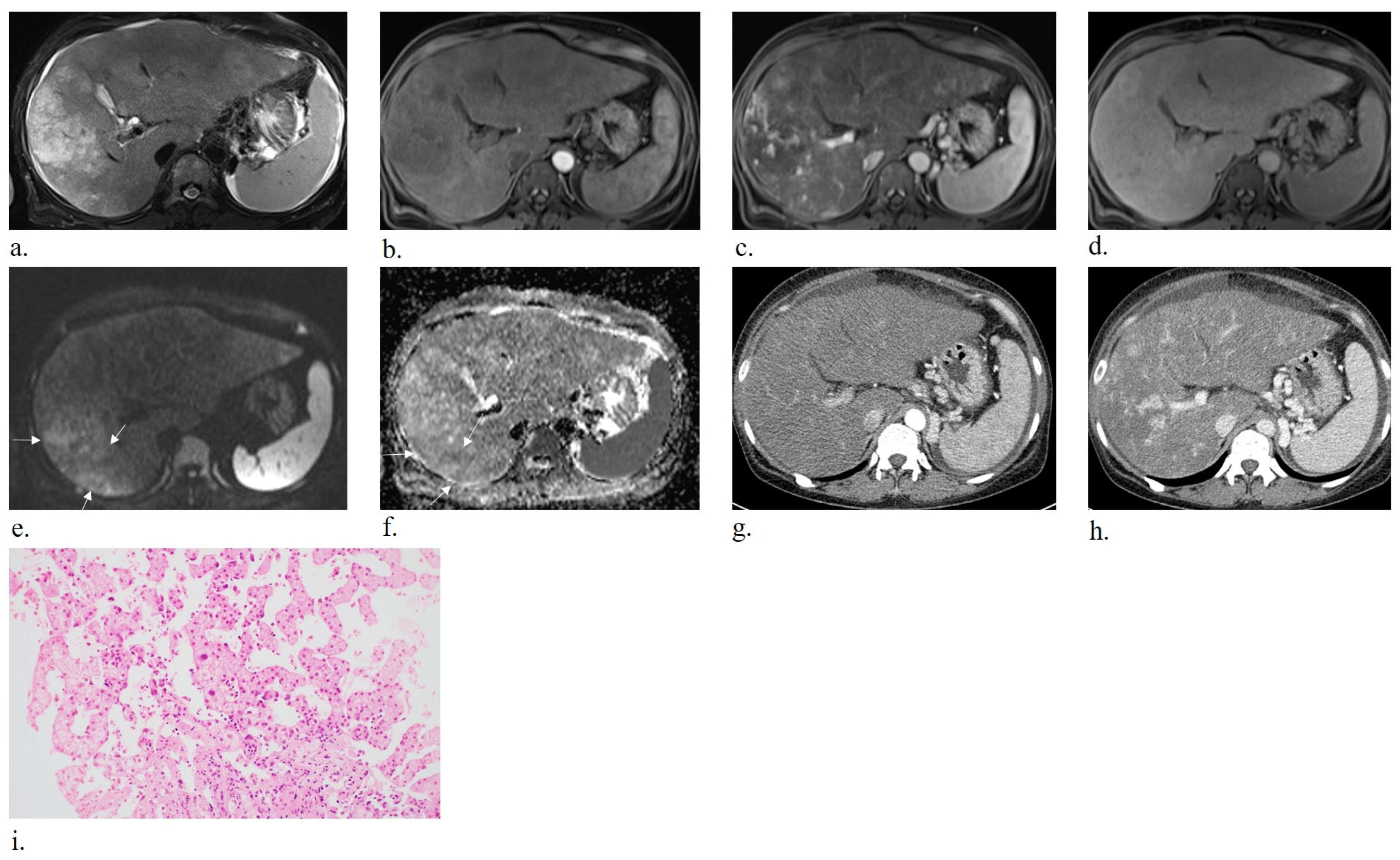 Primary Hepatic Angiosarcoma: Distinct Imaging Phenotypes Mirroring ...